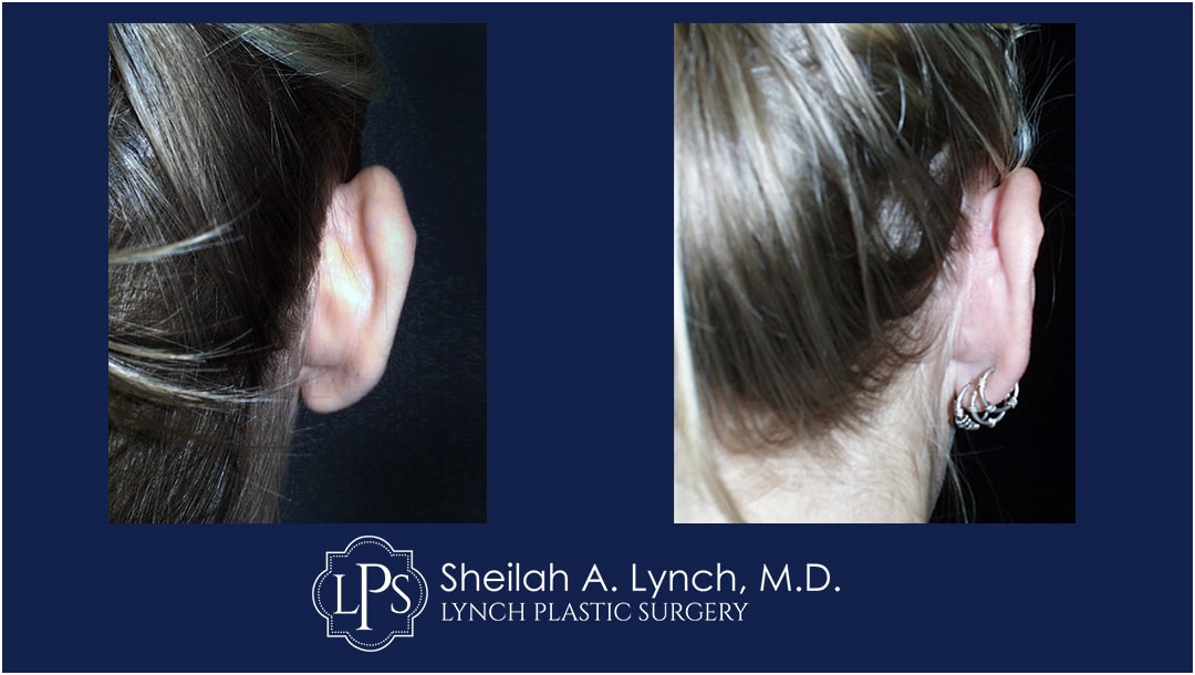 Expert Ear Pinning Otoplasty Surgery Visit Our Photo Gallery