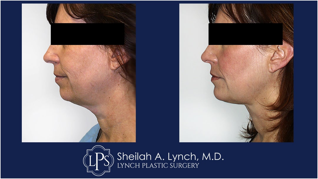 AMAZING Neck Lift Surgery Results! Before After Images Photo Gallery