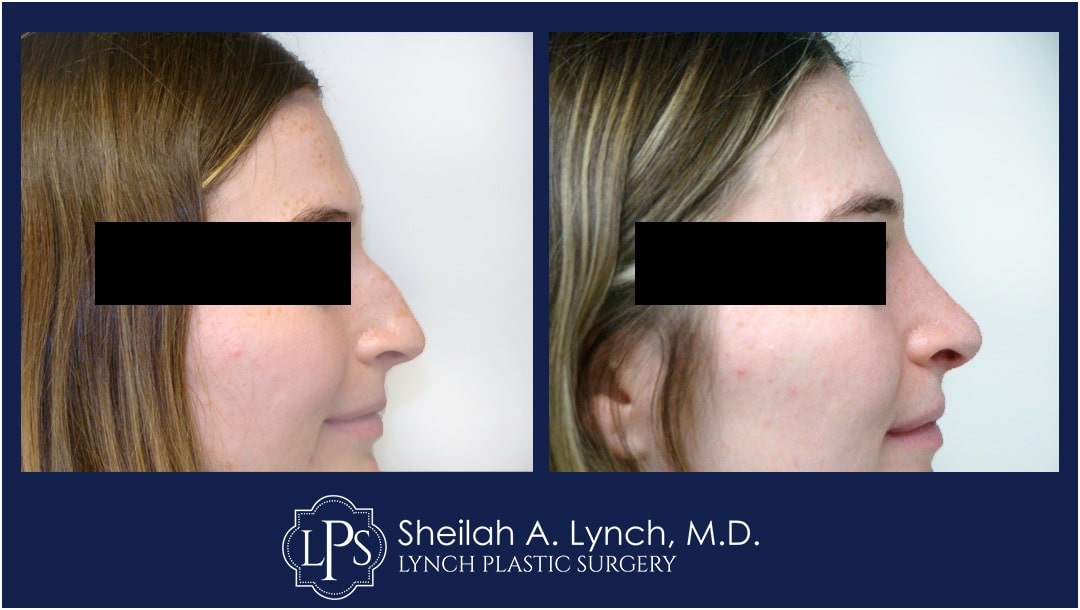 Expert Rhinoplasty Nose Reshaping Surgery Maryland