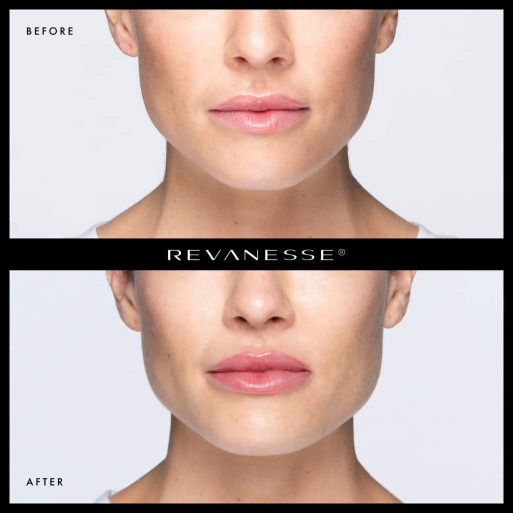 $550 Versa Lip Filler Promotion (Save $100) Lip Injections Easton