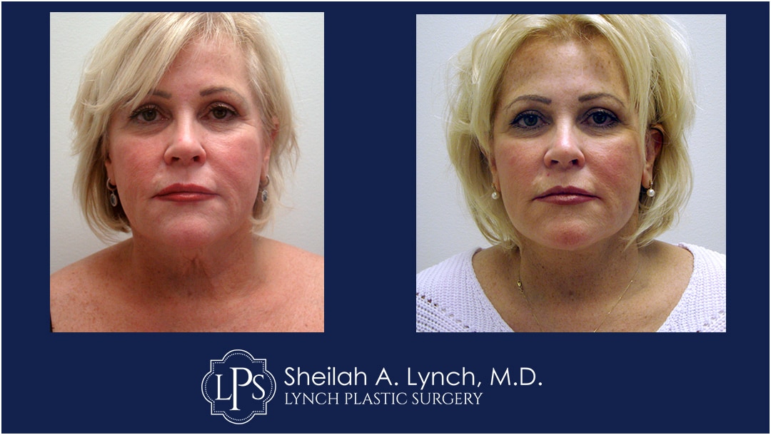 Slimming MACS Lift Before After Patient 1 Neck Lift Images