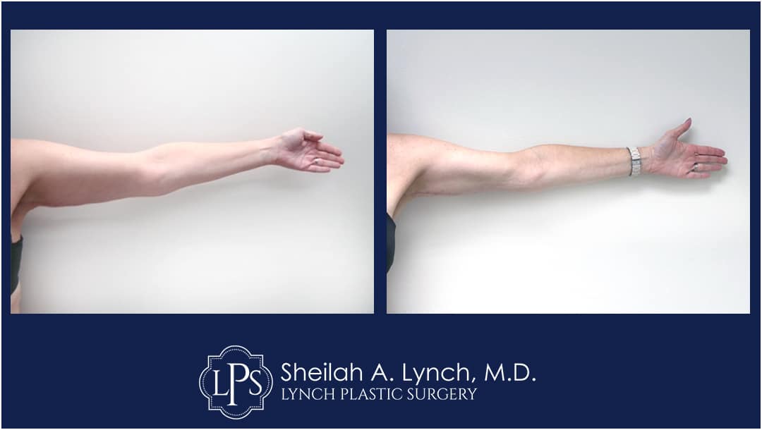 Arm Lift Before After Patient 7 images, Upper Arm Lift / Lipo