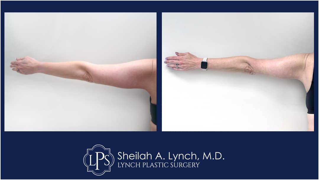 Arm Lift Before After Patient 7 images, Upper Arm Lift / Lipo