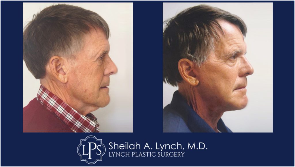 Male MACS Lift Before After Patient 2 Easton Chevy Chase Maryland