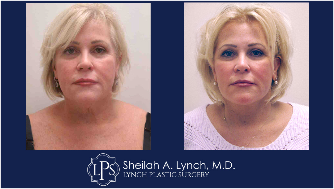 Slimming MACS Lift Before After Patient 1 Neck Lift Images