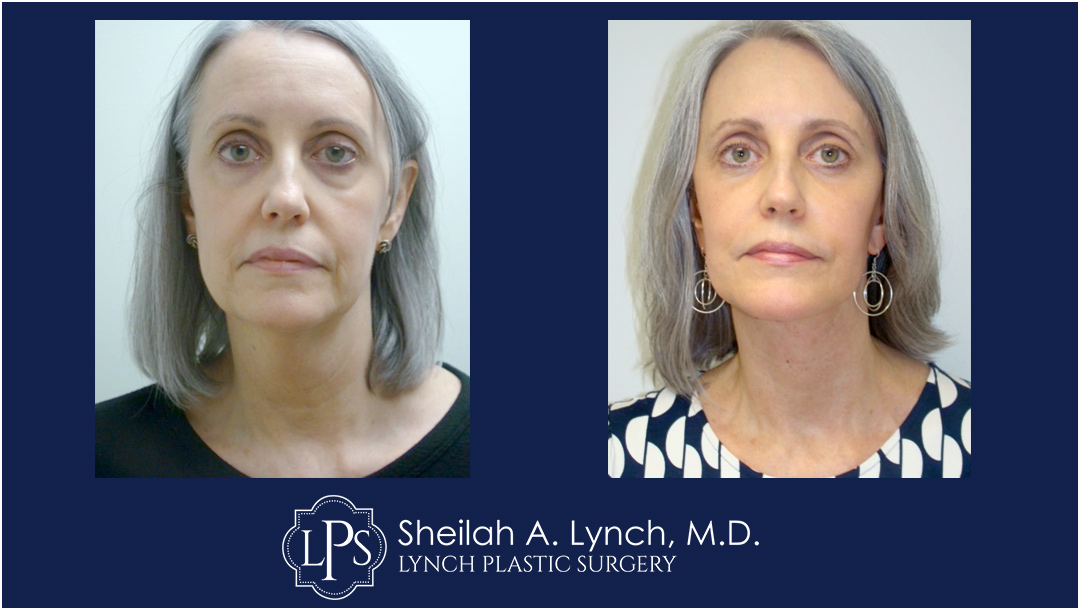 #1 Natural Neck Lift Results - MACS Lift Before After Patient