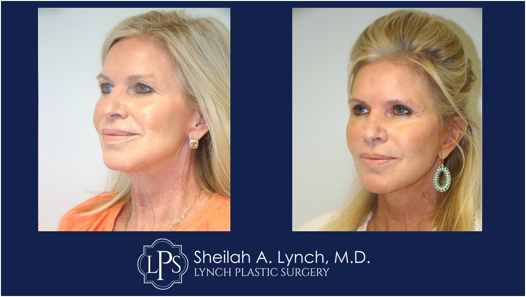 Excellent Results ! Washington DC Vertical Facelift Patient 1 Before After
